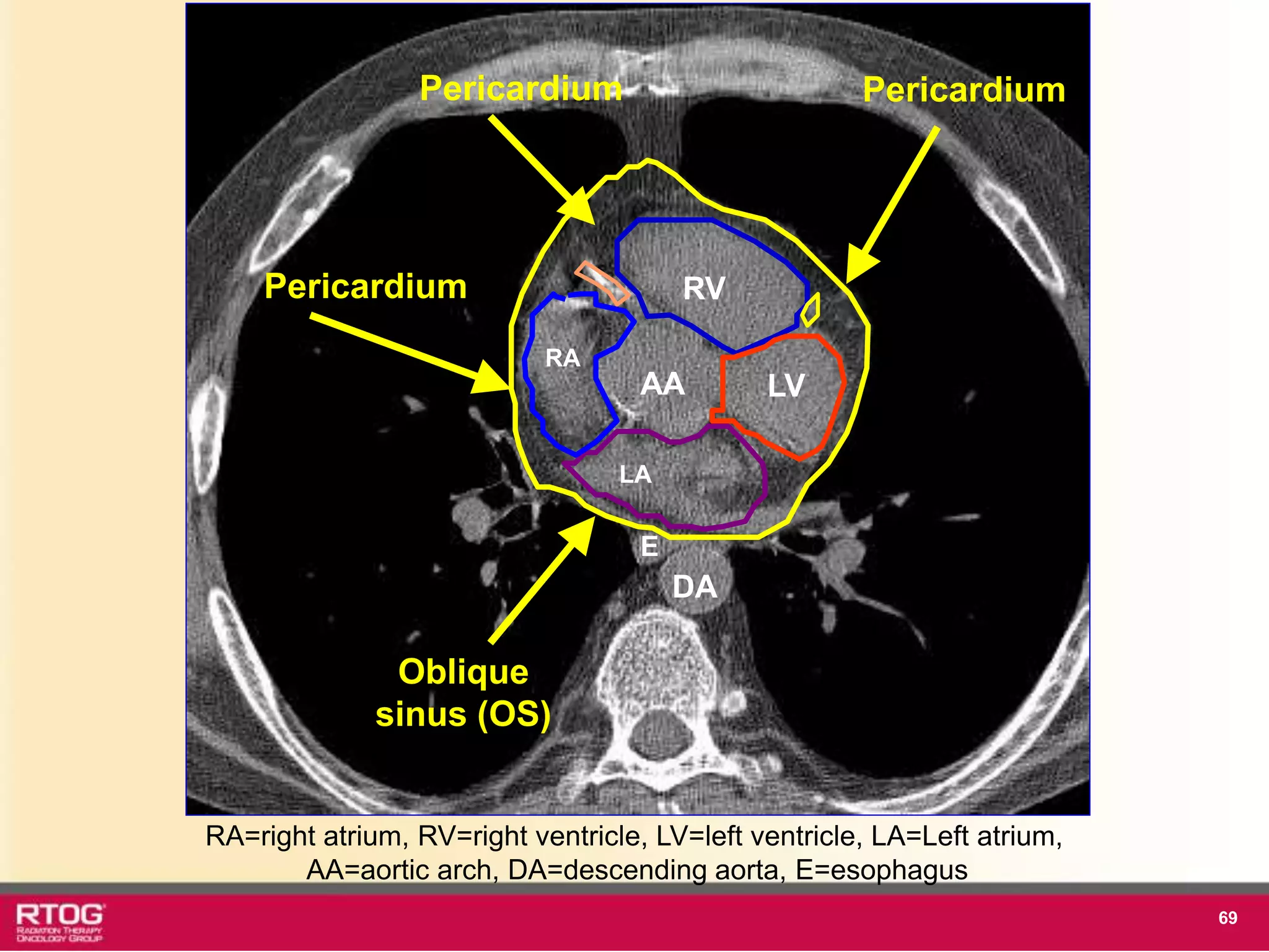 RTOG 1106 OAR Atlas Thoracic Radiation Therapy.ppt