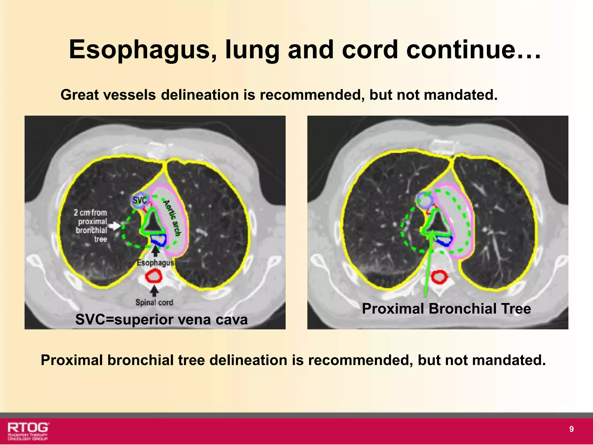 RTOG 1106 OAR Atlas Thoracic Radiation Therapy.ppt