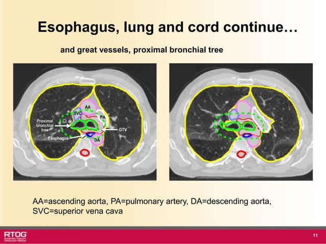 RTOG 1106 OAR Atlas Thoracic Radiation Therapy.ppt
