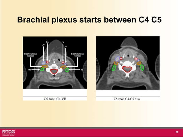 RTOG 1106 OAR Atlas Thoracic Radiation Therapy.ppt