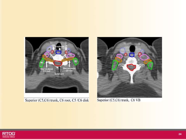 RTOG 1106 OAR Atlas Thoracic Radiation Therapy.ppt