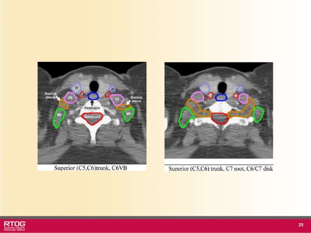 RTOG 1106 OAR Atlas Thoracic Radiation Therapy.ppt