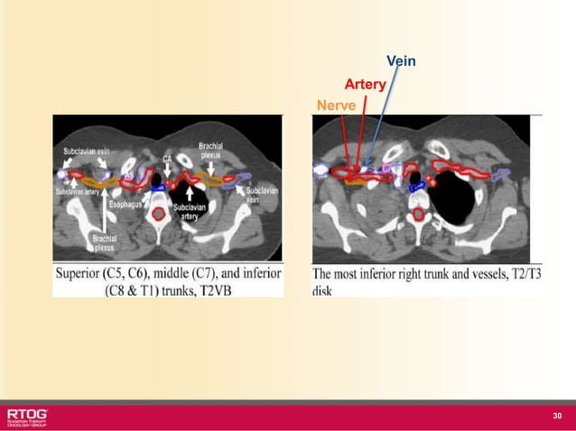 RTOG 1106 OAR Atlas Thoracic Radiation Therapy.ppt