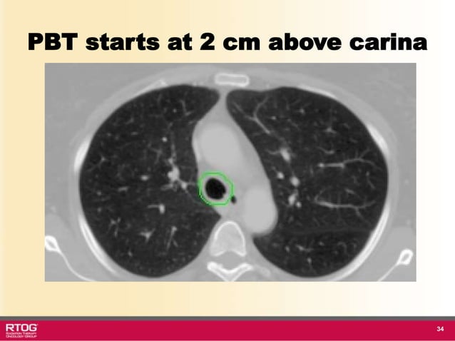RTOG 1106 OAR Atlas Thoracic Radiation Therapy.ppt