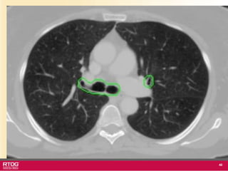RTOG 1106 OAR Atlas Thoracic Radiation Therapy.ppt