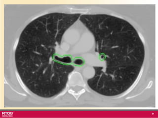 RTOG 1106 OAR Atlas Thoracic Radiation Therapy.ppt