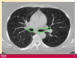 RTOG 1106 OAR Atlas Thoracic Radiation Therapy.ppt