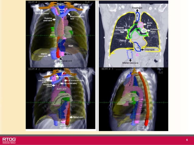 RTOG 1106 OAR Atlas Thoracic Radiation Therapy.ppt