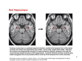 RTOG_Contouring_Guidelines-Hippocampus_version2.ppt