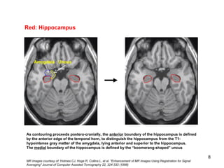 RTOG_Contouring_Guidelines-Hippocampus_version2.ppt