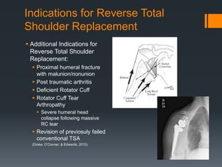 Reverse Total Shoulder Replacement: Anatomy, Rehabilitation, and ...