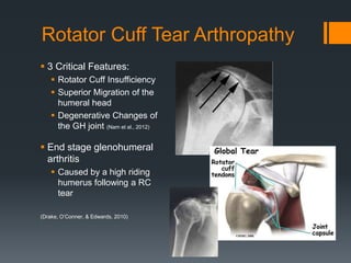 Reverse Total Shoulder Replacement: Anatomy, Rehabilitation, and ...