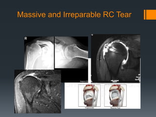 Reverse Total Shoulder Replacement: Anatomy, Rehabilitation, and ...