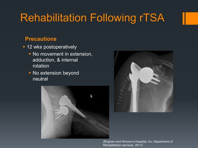 Reverse Total Shoulder Replacement: Anatomy, Rehabilitation, and ...
