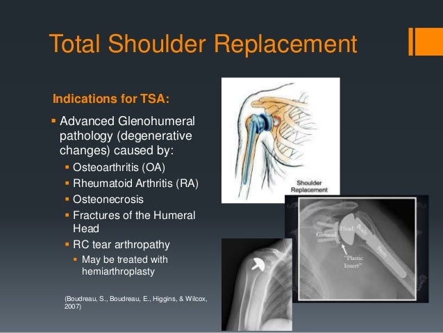 Reverse Total Shoulder Replacement: Anatomy, Rehabilitation, and Clin…