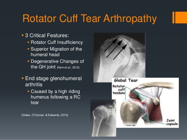 Reverse Total Shoulder Replacement: Anatomy, Rehabilitation, and Clin…