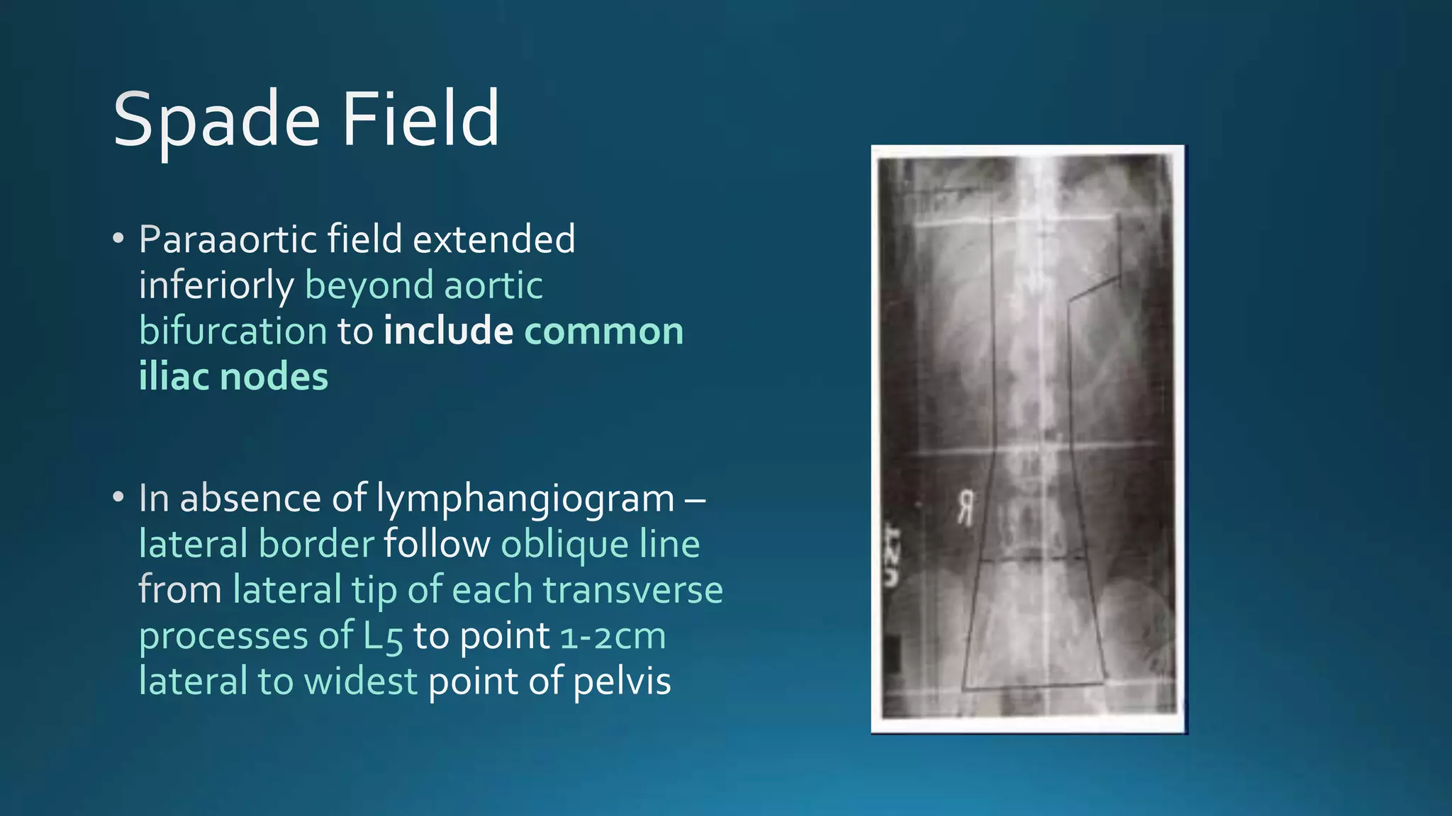 Radiotherapy in Hodgkin's lymphoma.pptx