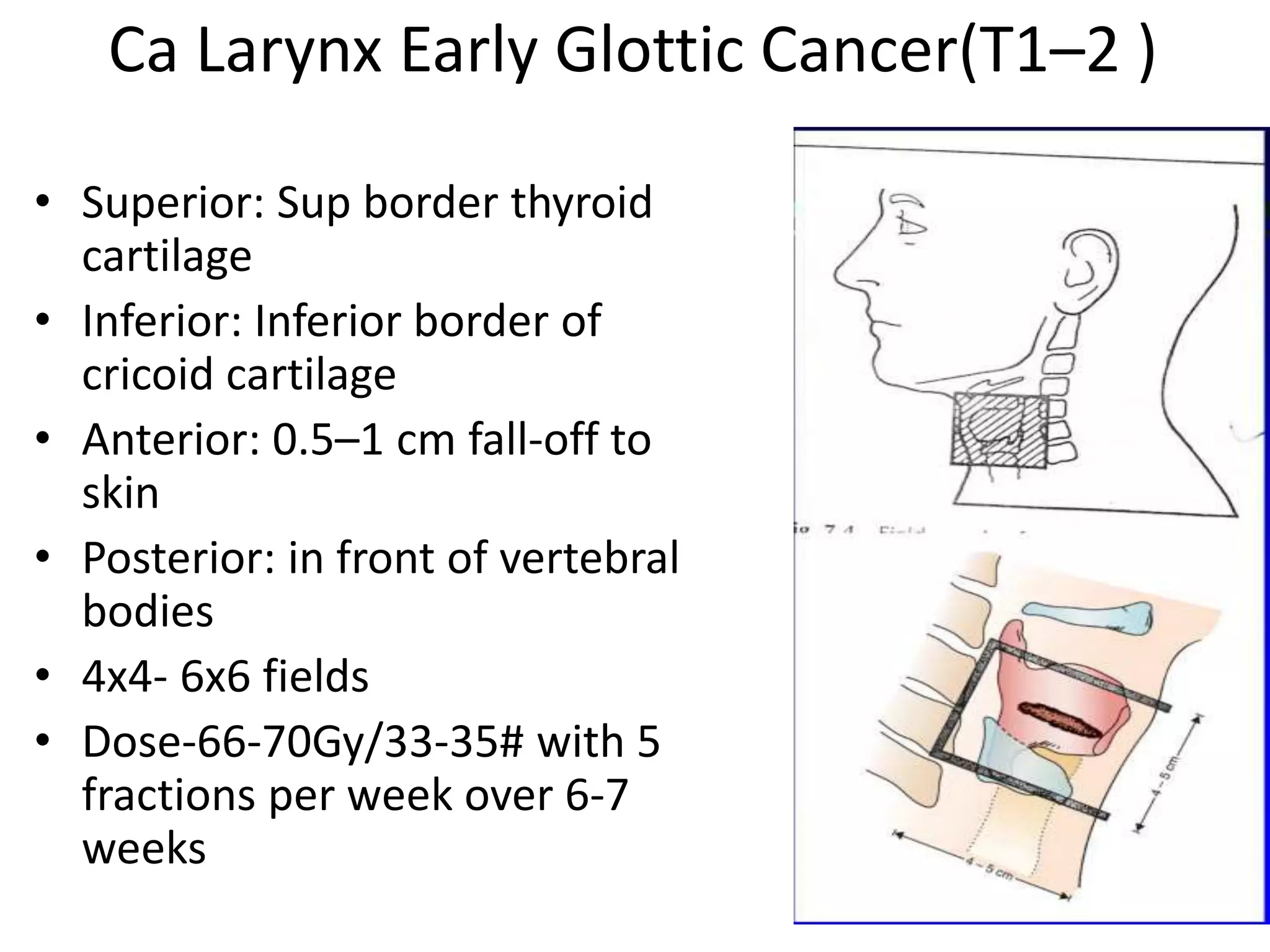 Rt techniques in ca larynx | PPTX