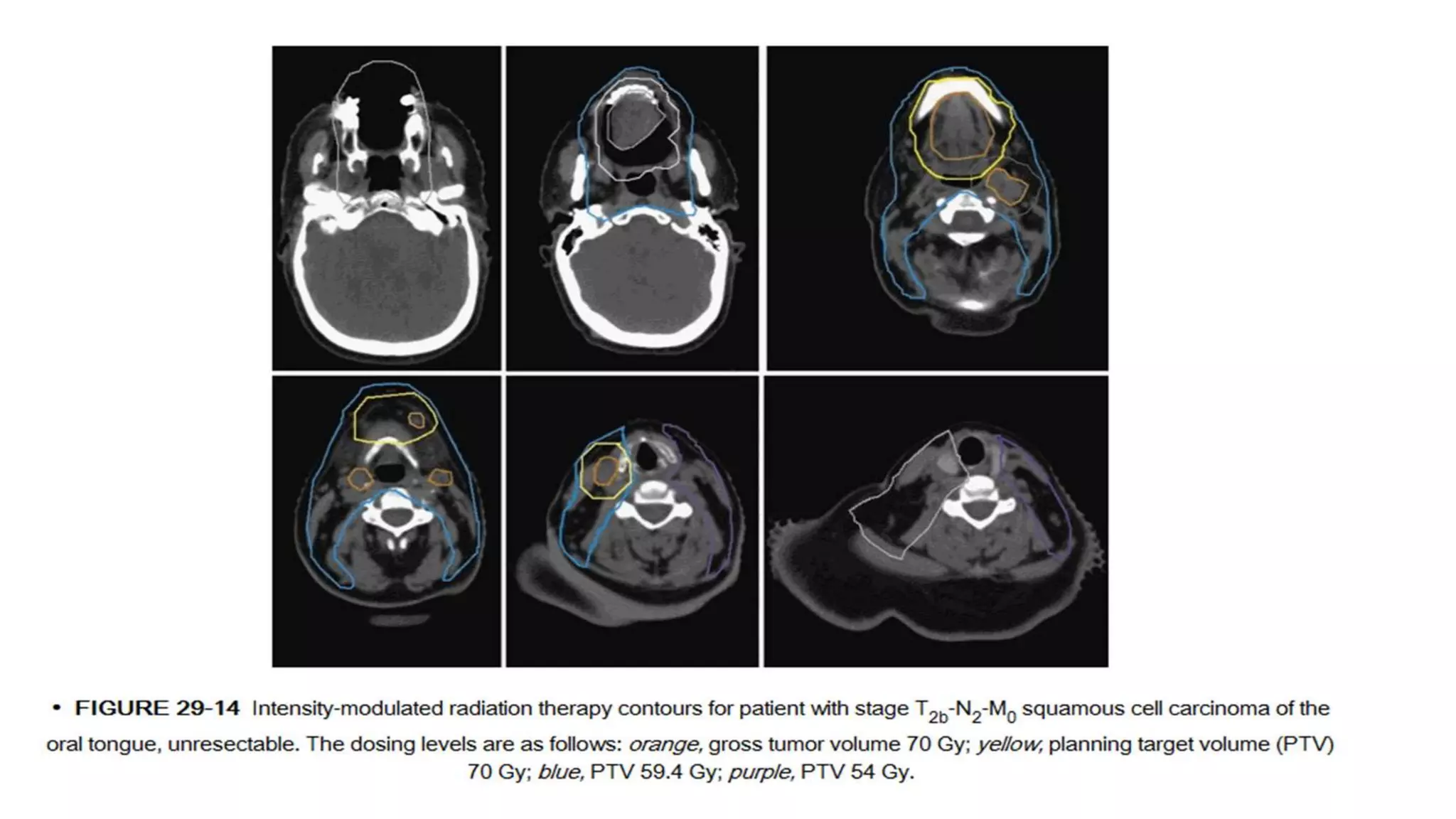 Radiotherapy techniques, indications and evidences in oral cavity and ...