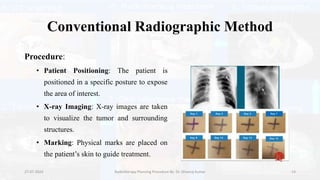 Radiotherapy Treatment Planning Procedure.pptx