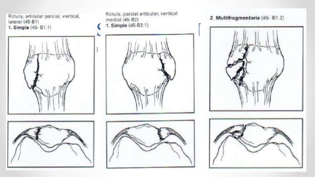 Fractura de rótula (1)