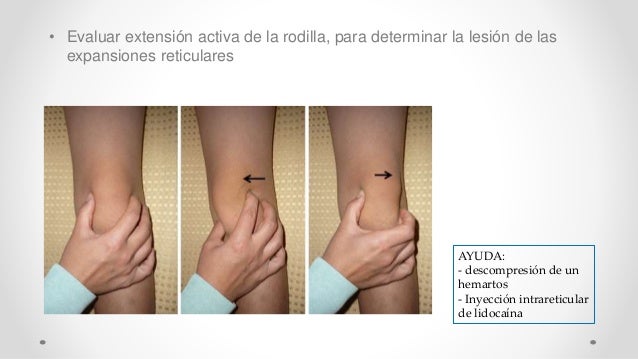 Fractura De Rótula 1