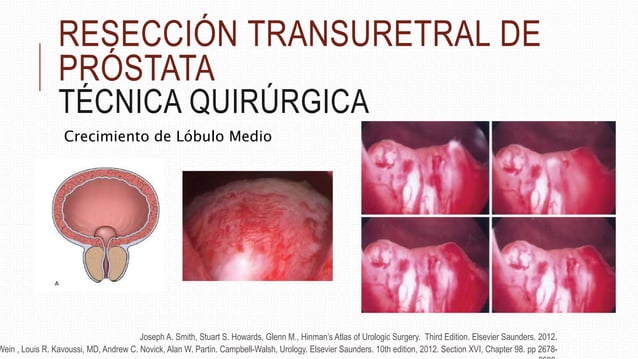 Reseccion Transuretral de Prostata, tecnica quirurgica | PPT