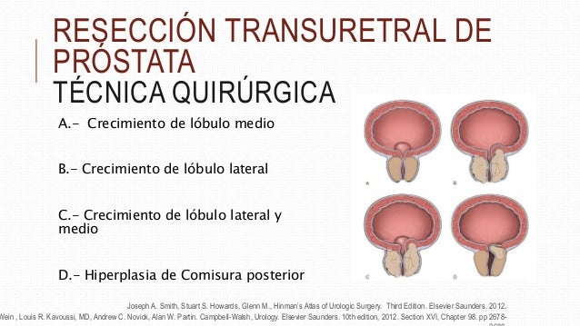 Reseccion Transuretral de Prostata, tecnica quirurgica
