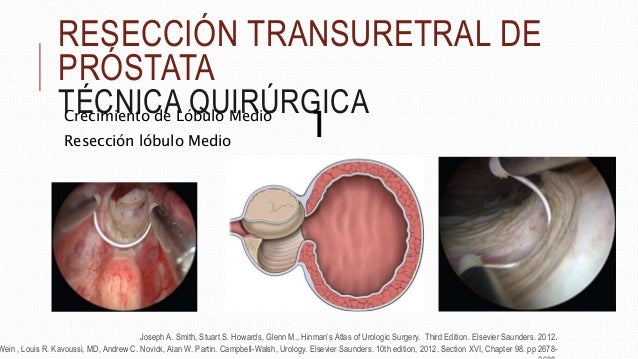 Reseccion Transuretral de Prostata, tecnica quirurgica