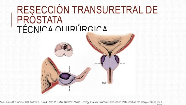 Reseccion Transuretral de Prostata, tecnica quirurgica