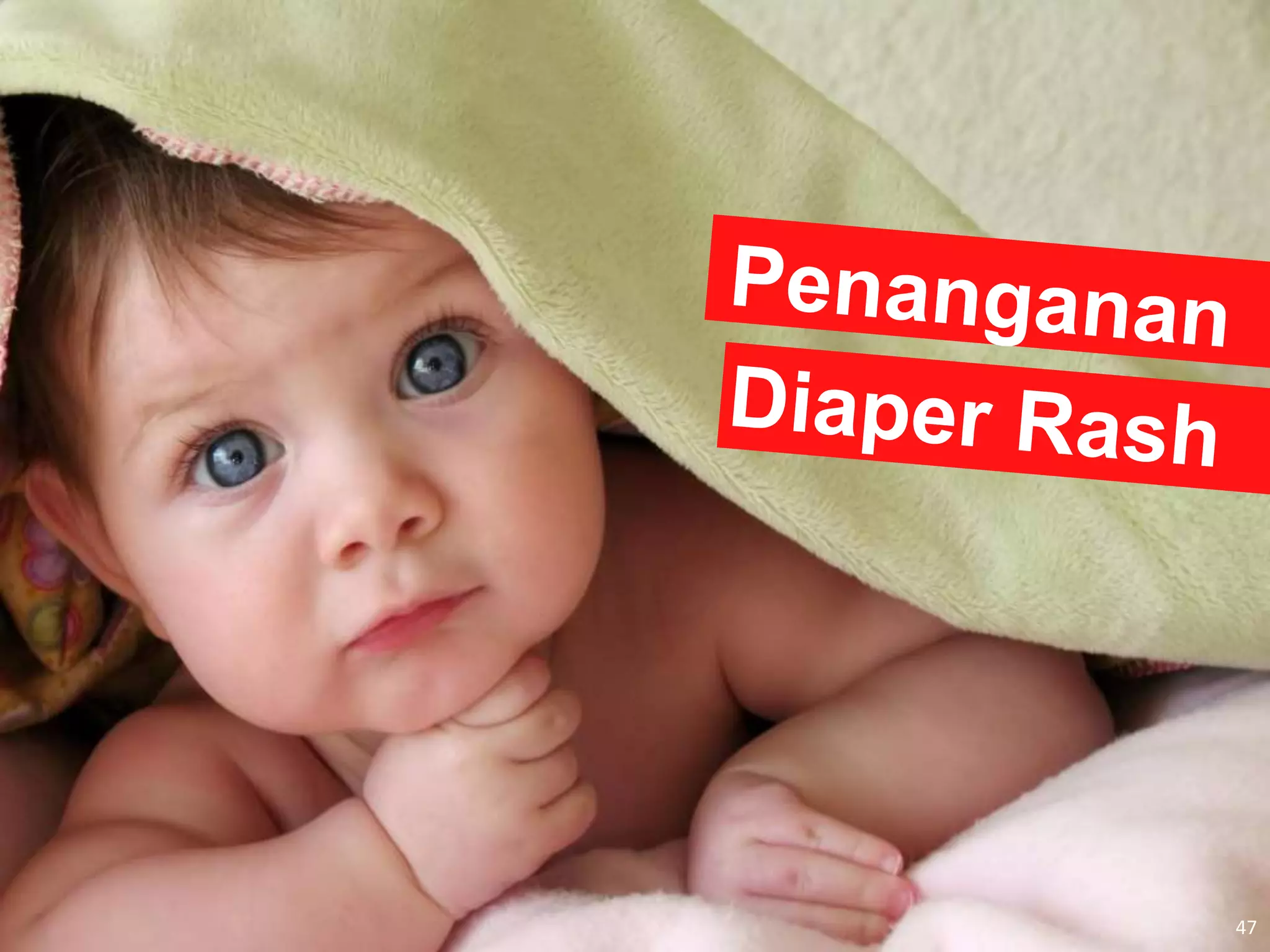 Ruam popok pada bayi & anak | PPTX