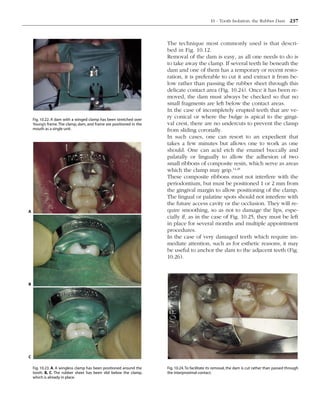 Rubber dam | PDF