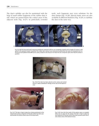 Rubber dam | PDF