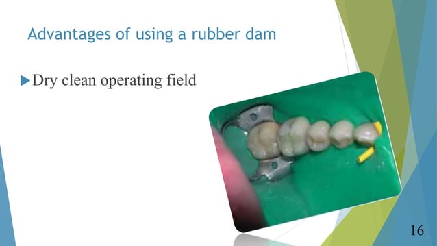 RUBBER DAM IN ENDODONTICS | PPTX | Dental Health | Diseases and Conditions