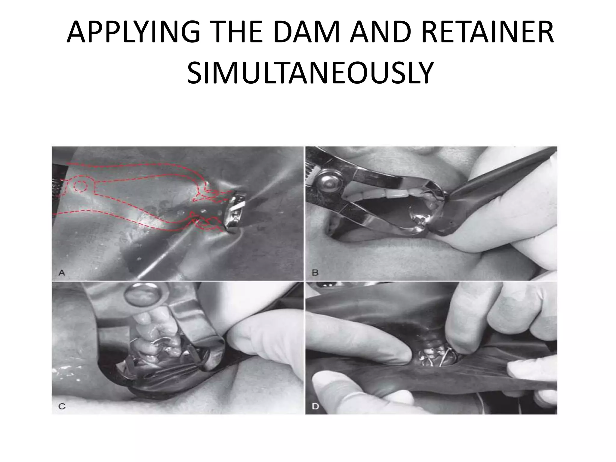 Rubber dam application | PPTX