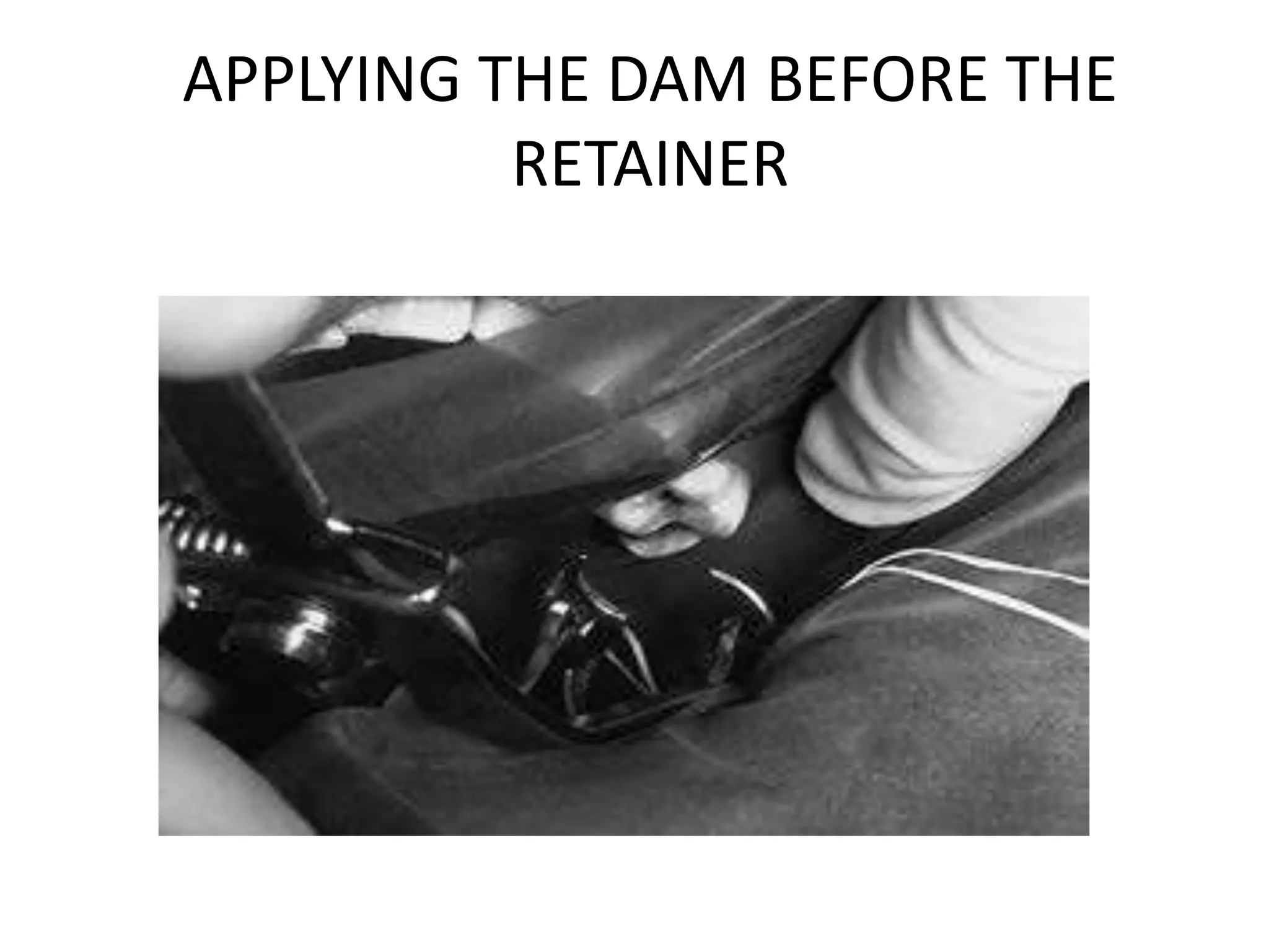 Rubber dam application | PPTX