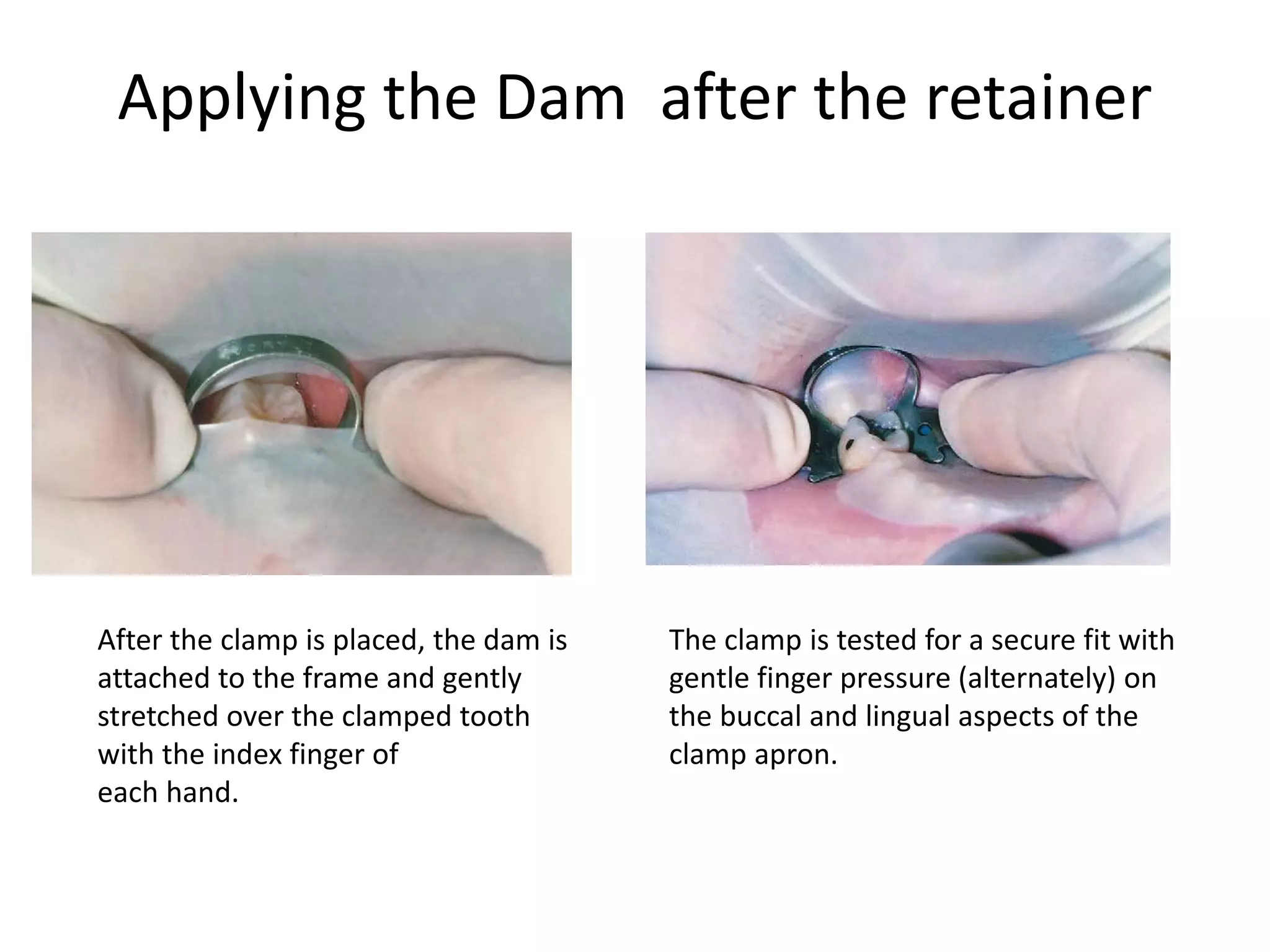 Rubber dam application | PPTX