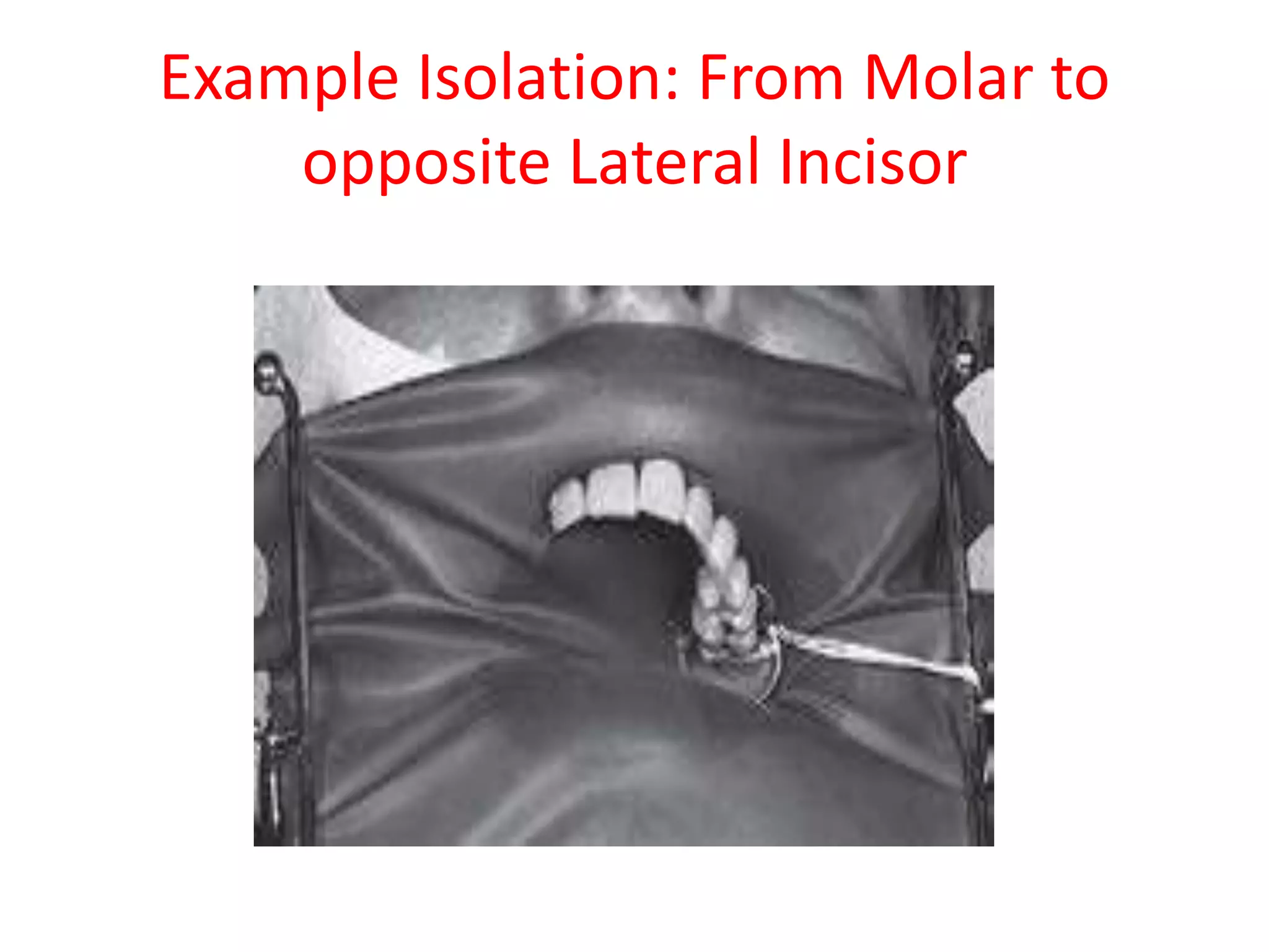 Rubber dam application | PPTX