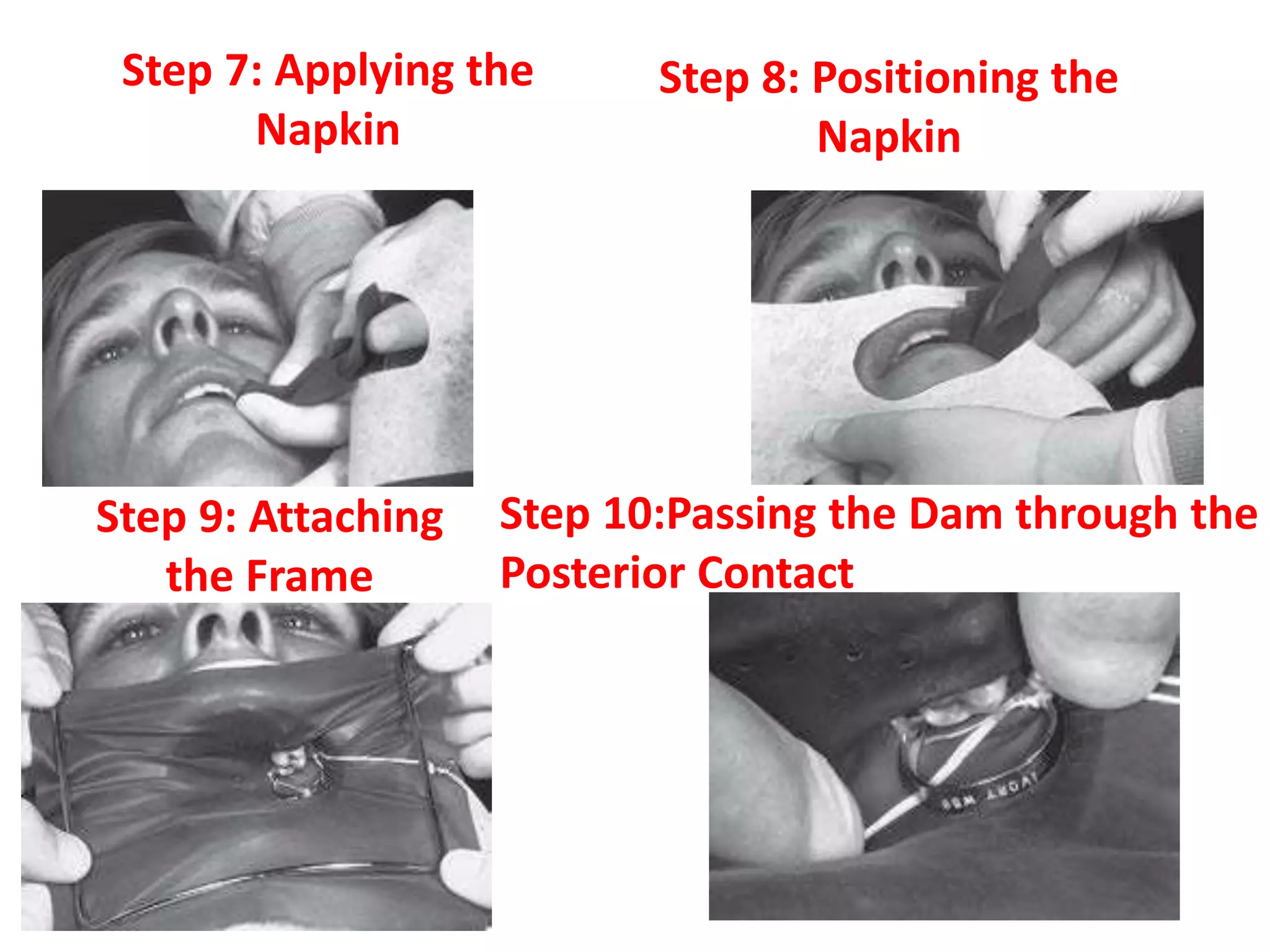 Rubber dam application | PPTX
