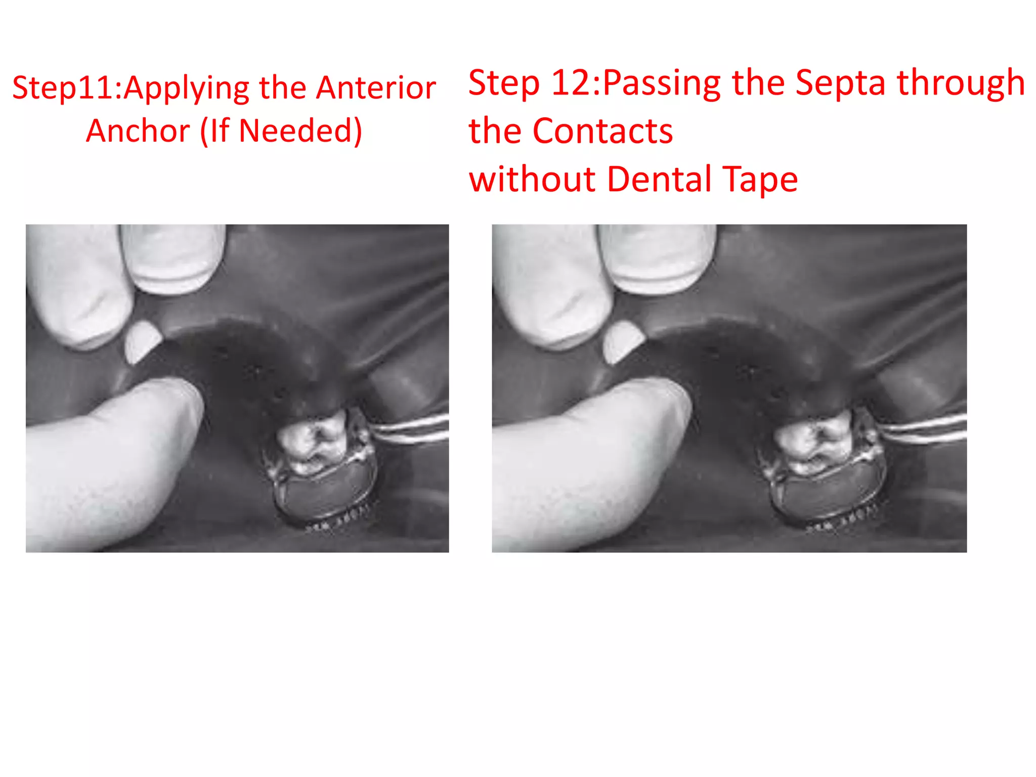 Rubber dam application | PPTX