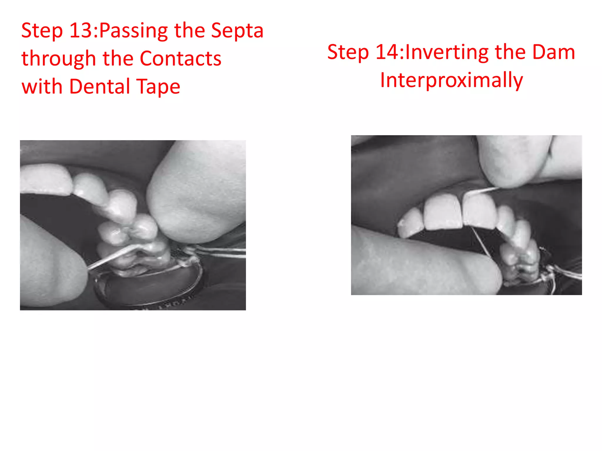 Rubber dam application | PPTX