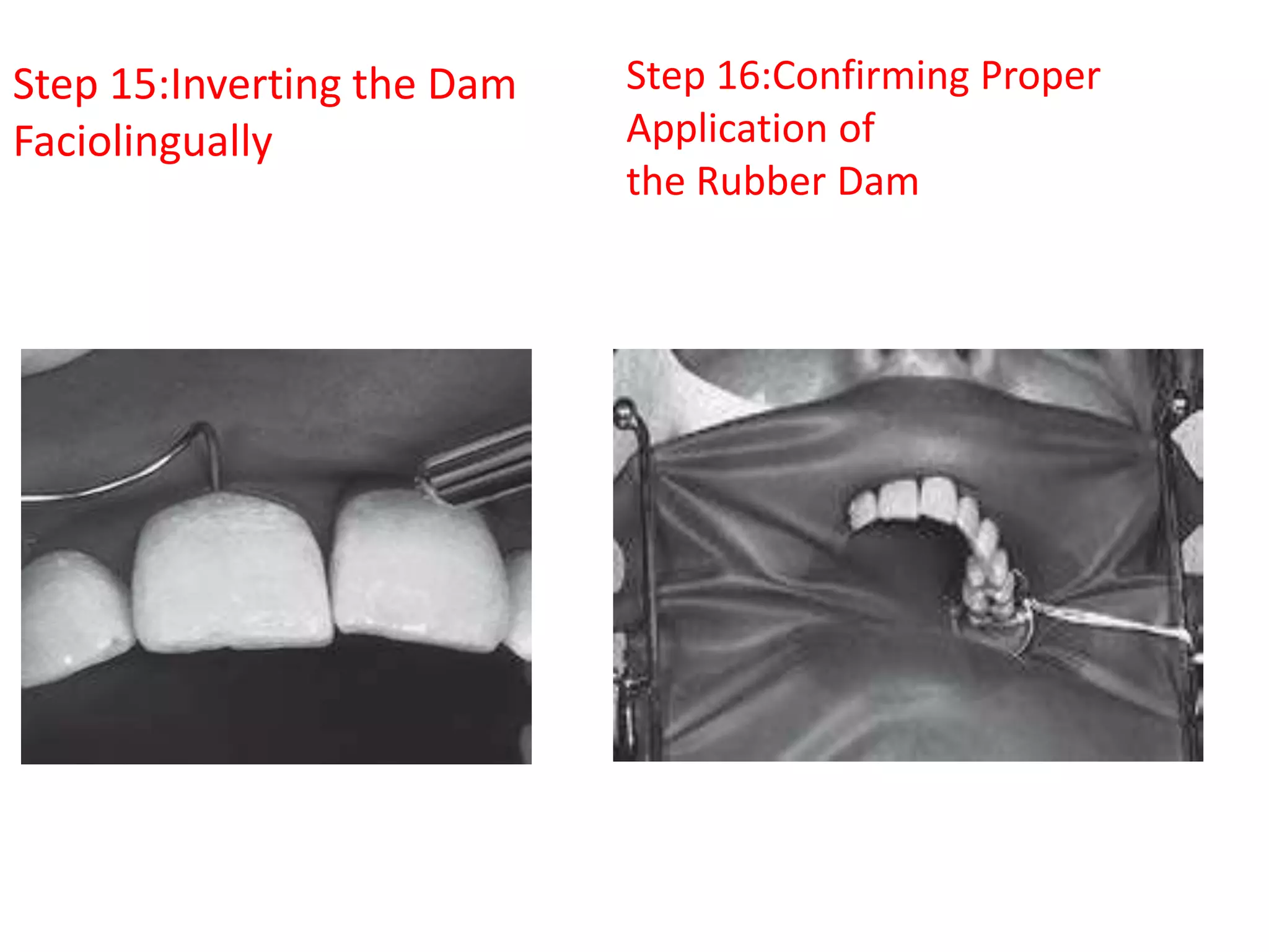 Rubber dam application | PPTX