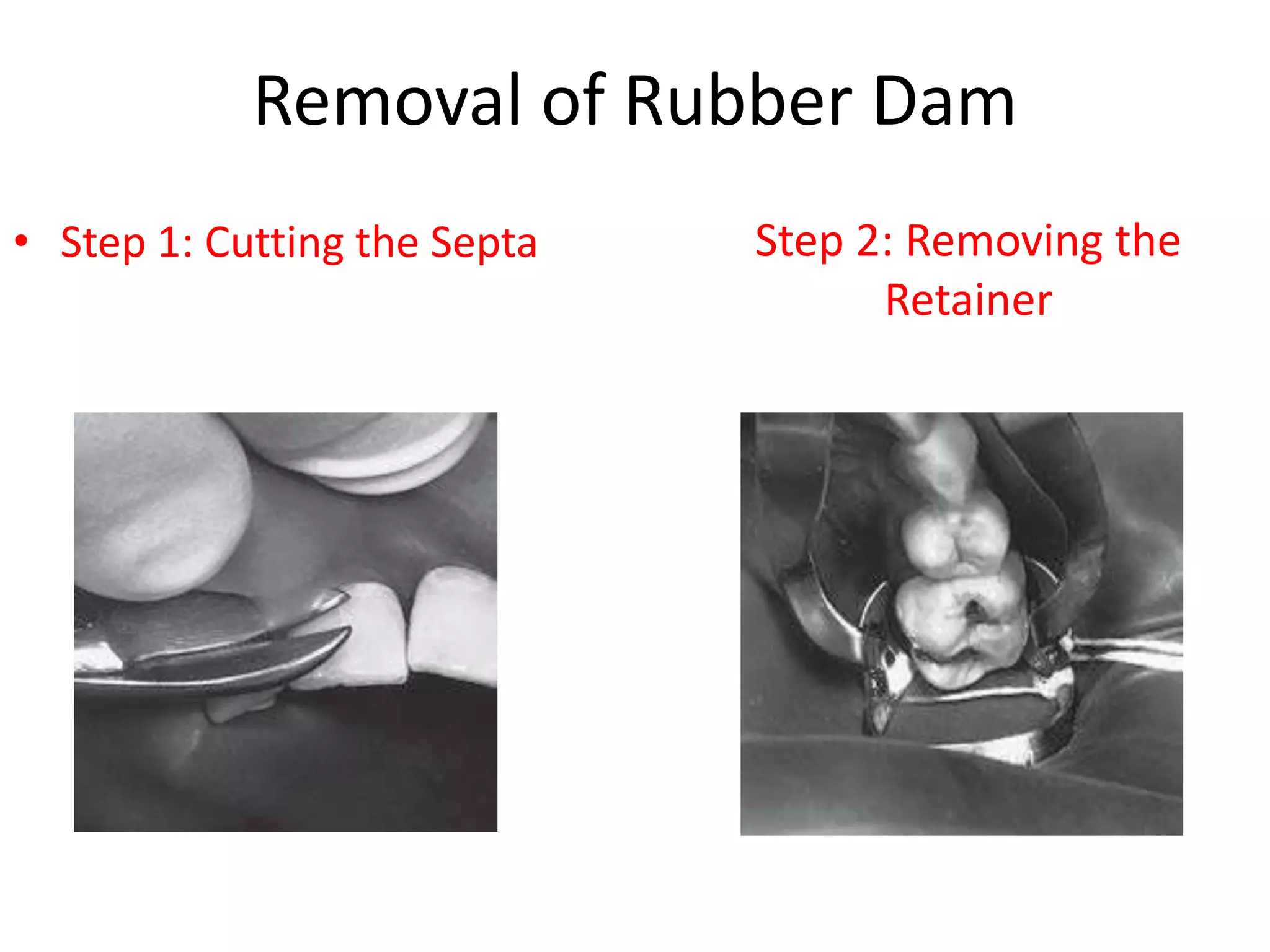 Rubber dam application | PPTX