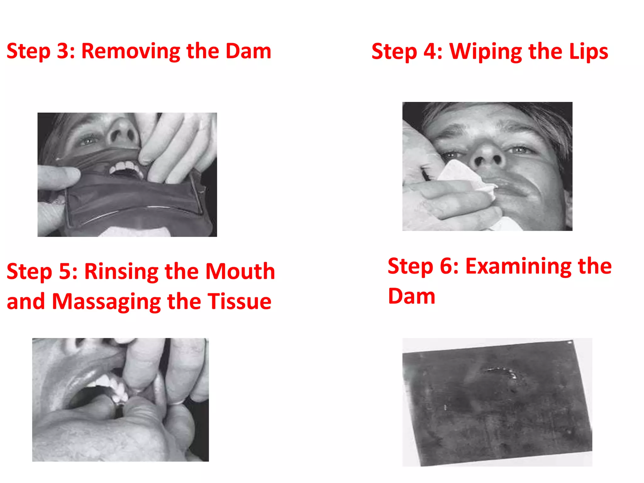 Rubber dam application | PPTX