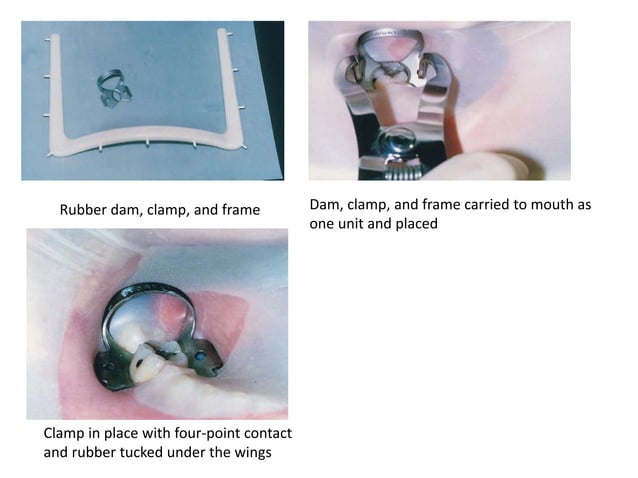 Rubber dam application | PPTX | Oral care | Personal Care