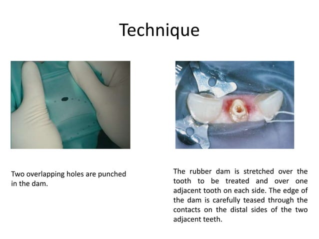 Rubber dam application | PPTX | Oral care | Personal Care