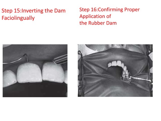 Rubber dam application | PPTX | Oral care | Personal Care