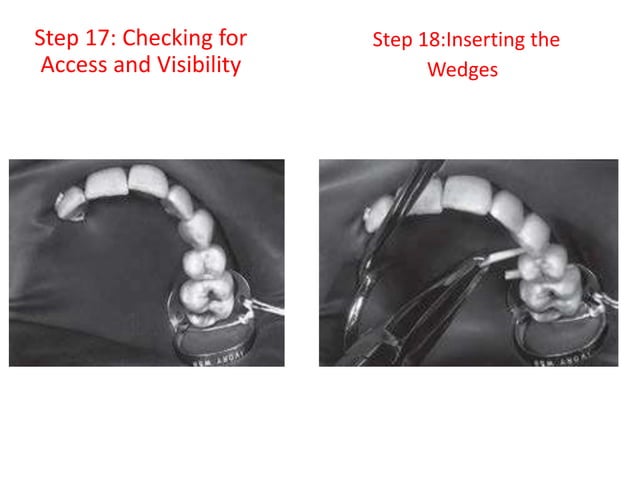 Rubber dam application | PPTX | Oral care | Personal Care
