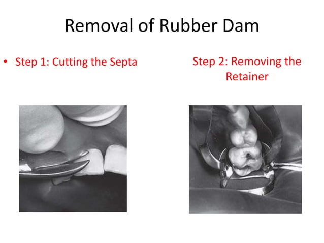 Rubber dam application | PPTX | Oral care | Personal Care
