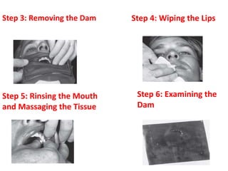 Rubber dam application | PPTX